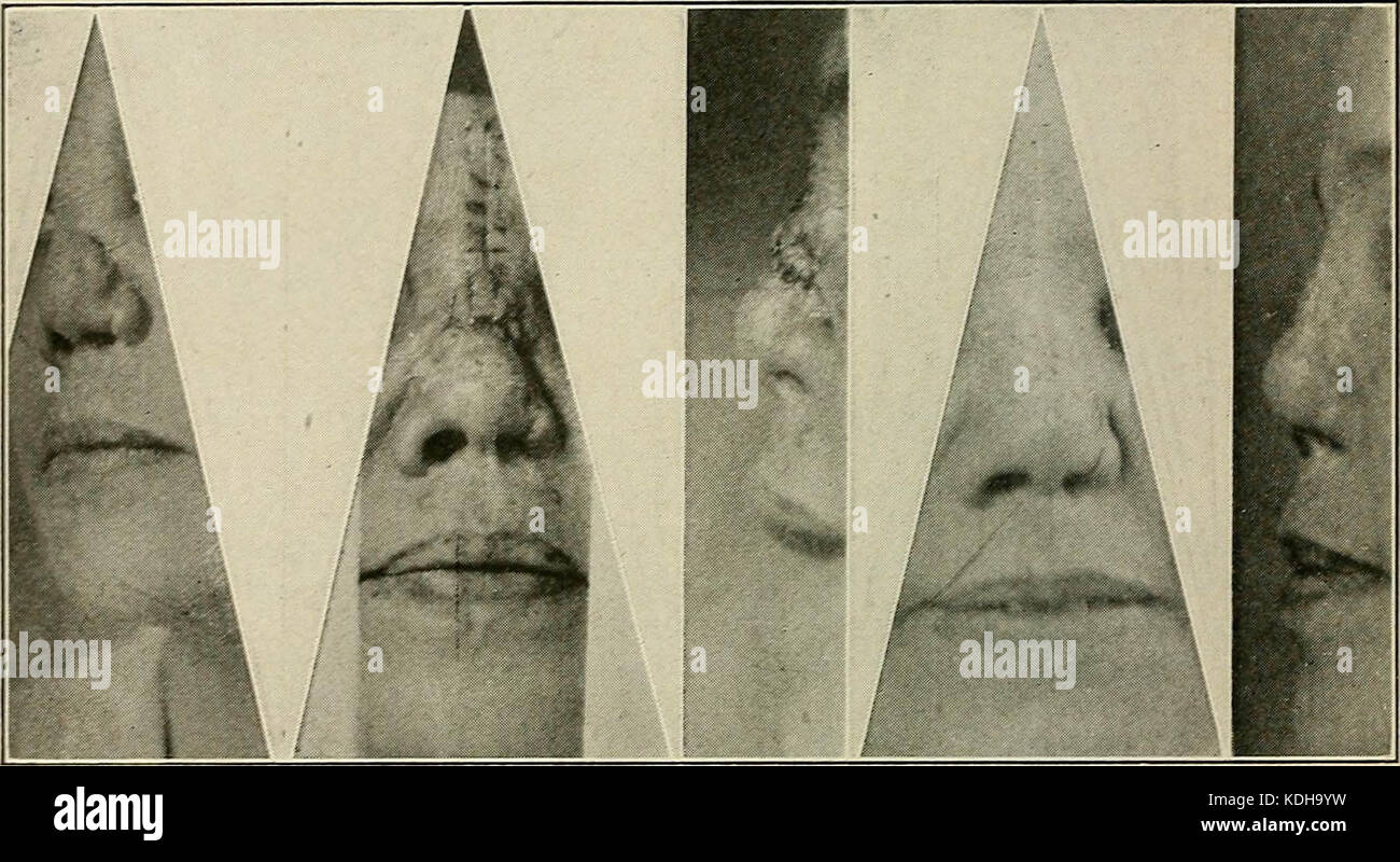 "Plastic surgery; its principles and practice" (1919 Stock Photo - Alamy