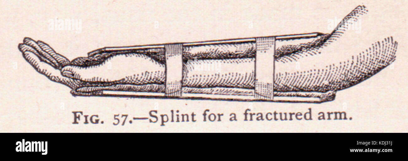 Splint for a Fractured arm Stock Photo - Alamy