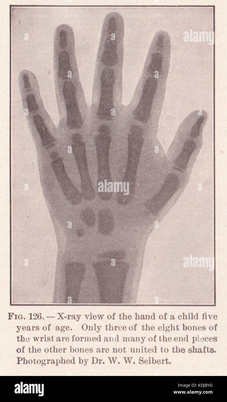 Xray hand child hi-res stock photography and images - Alamy