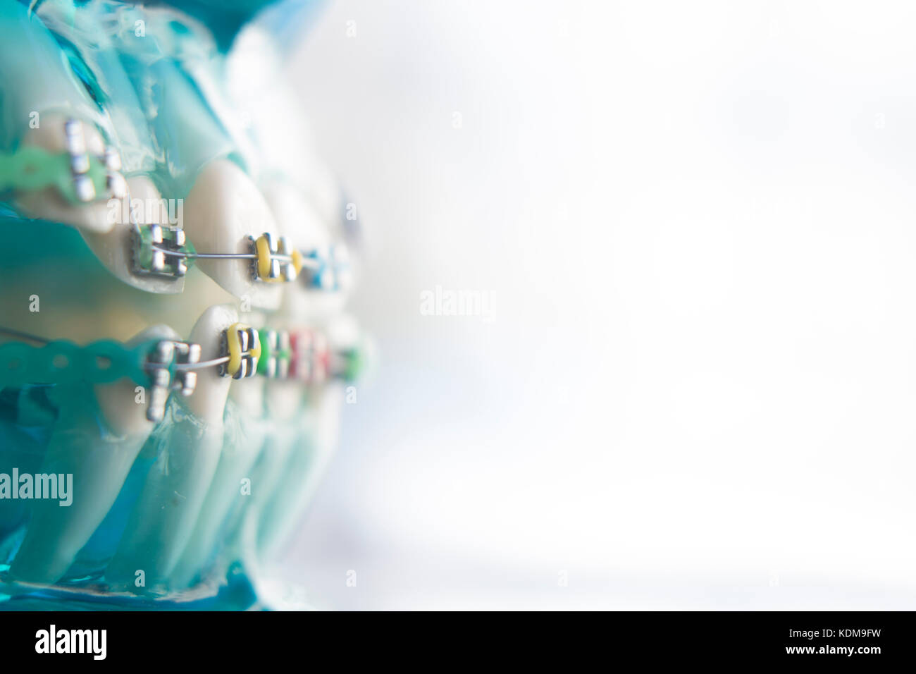 Dental teeth retainers metal aligners brackets to straighten teeth in ...