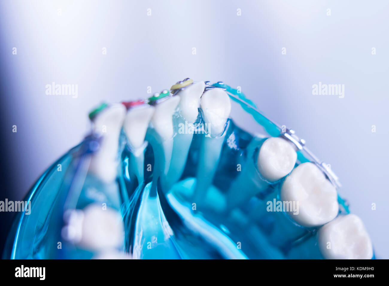 Dental teeth retainers metal aligners brackets to straighten teeth in ...