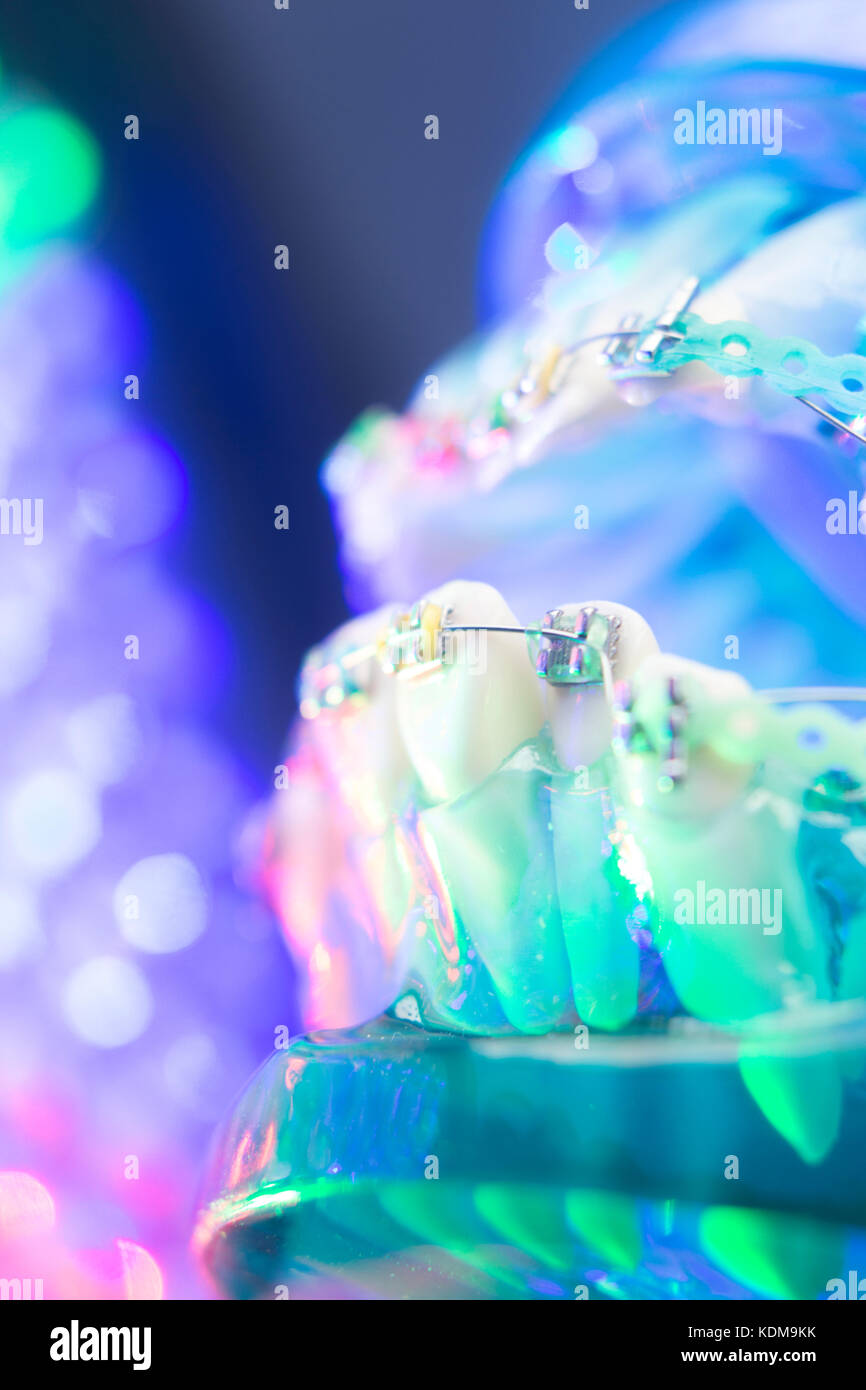 Dental teeth retainers metal aligners brackets to straighten teeth in ...