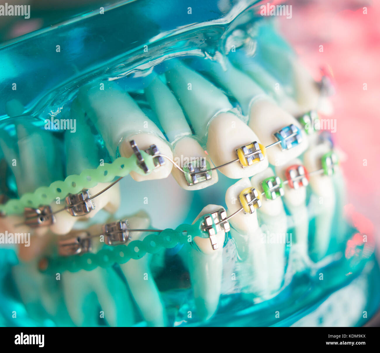 Dental teeth retainers metal aligners brackets to straighten teeth in ...