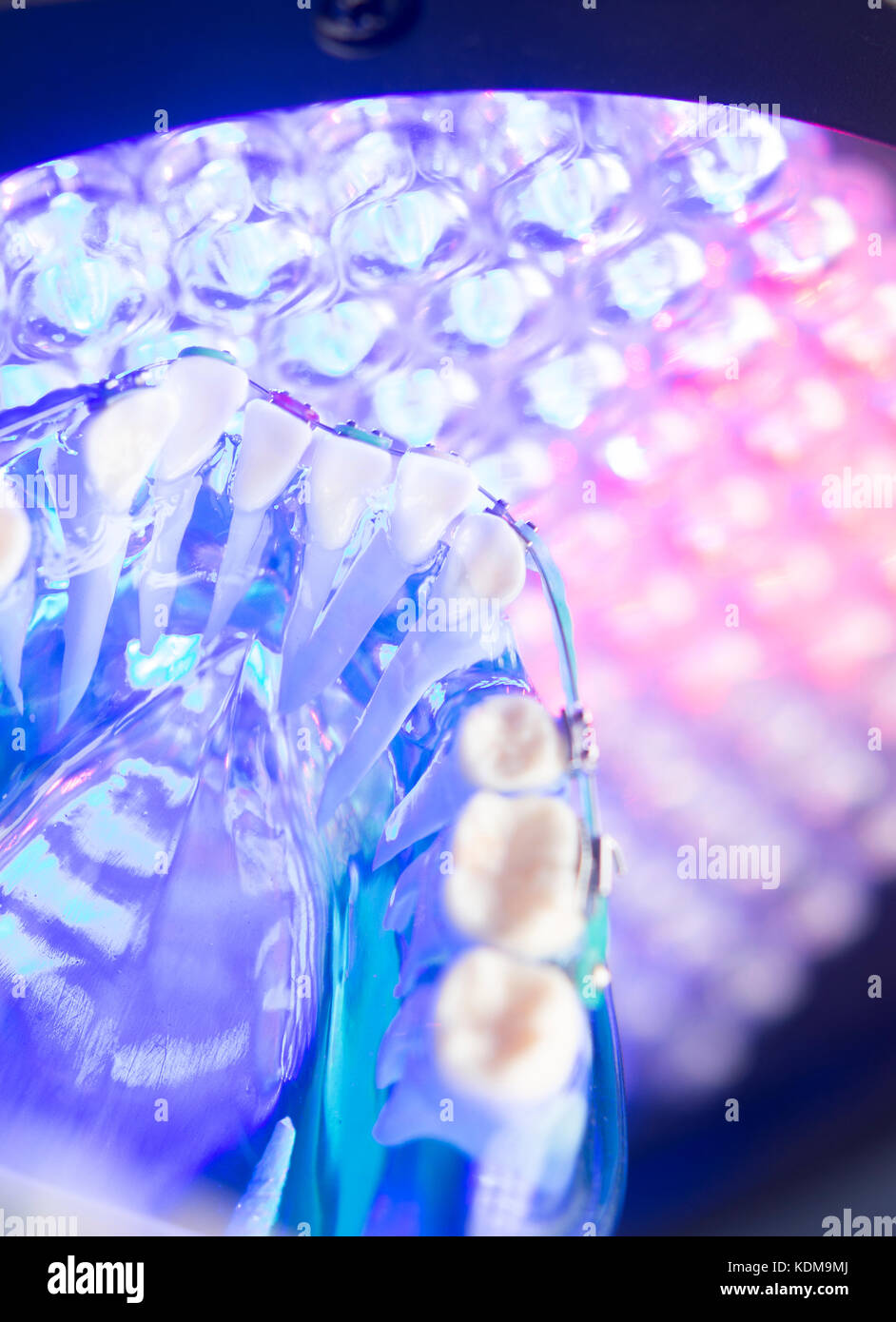 Dental teeth retainers metal aligners brackets to straighten teeth in ...