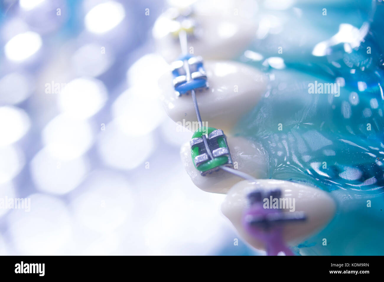 Dental teeth retainers metal aligners brackets to straighten teeth in ...