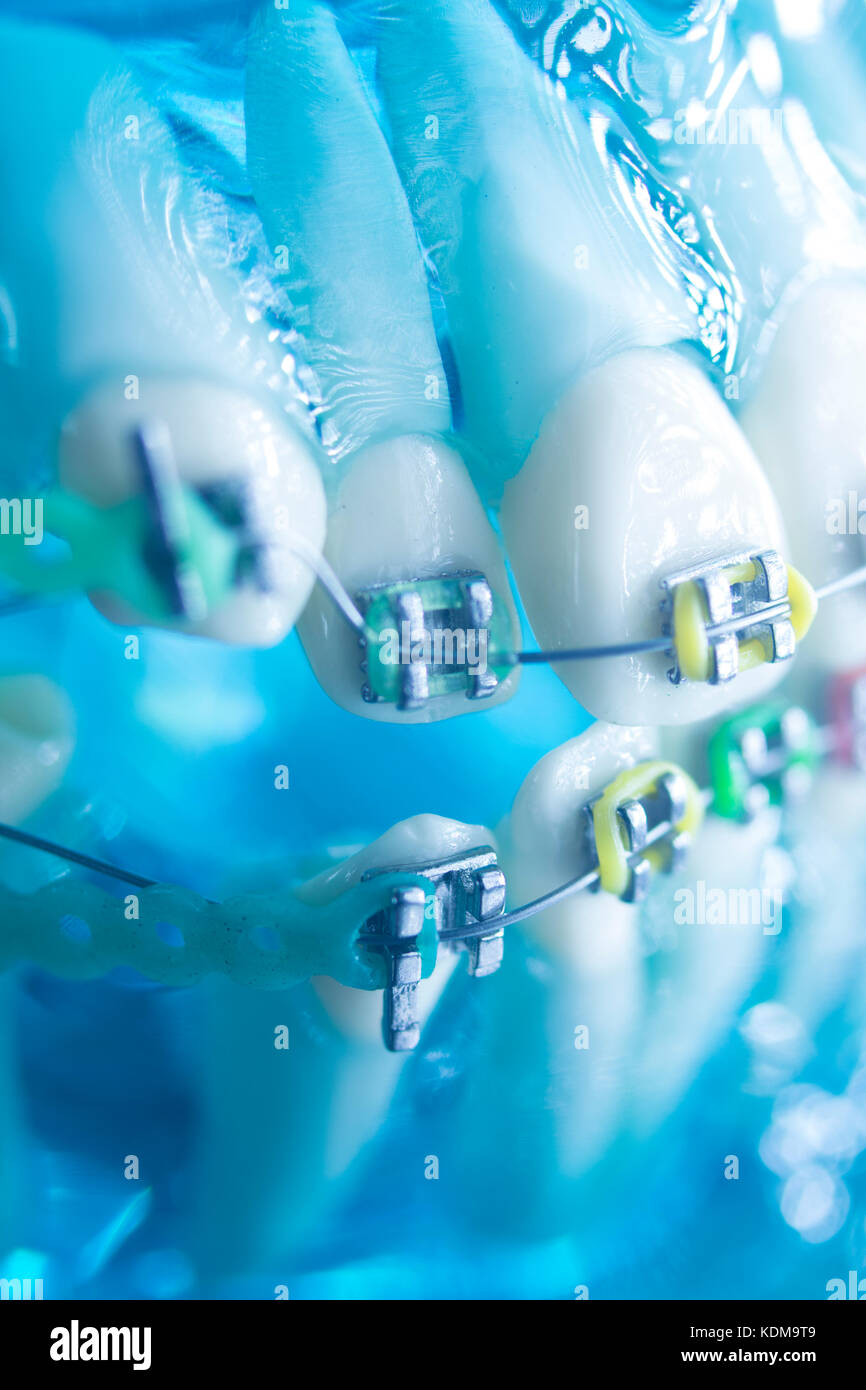 Dental teeth retainers metal aligners brackets to straighten teeth in ...