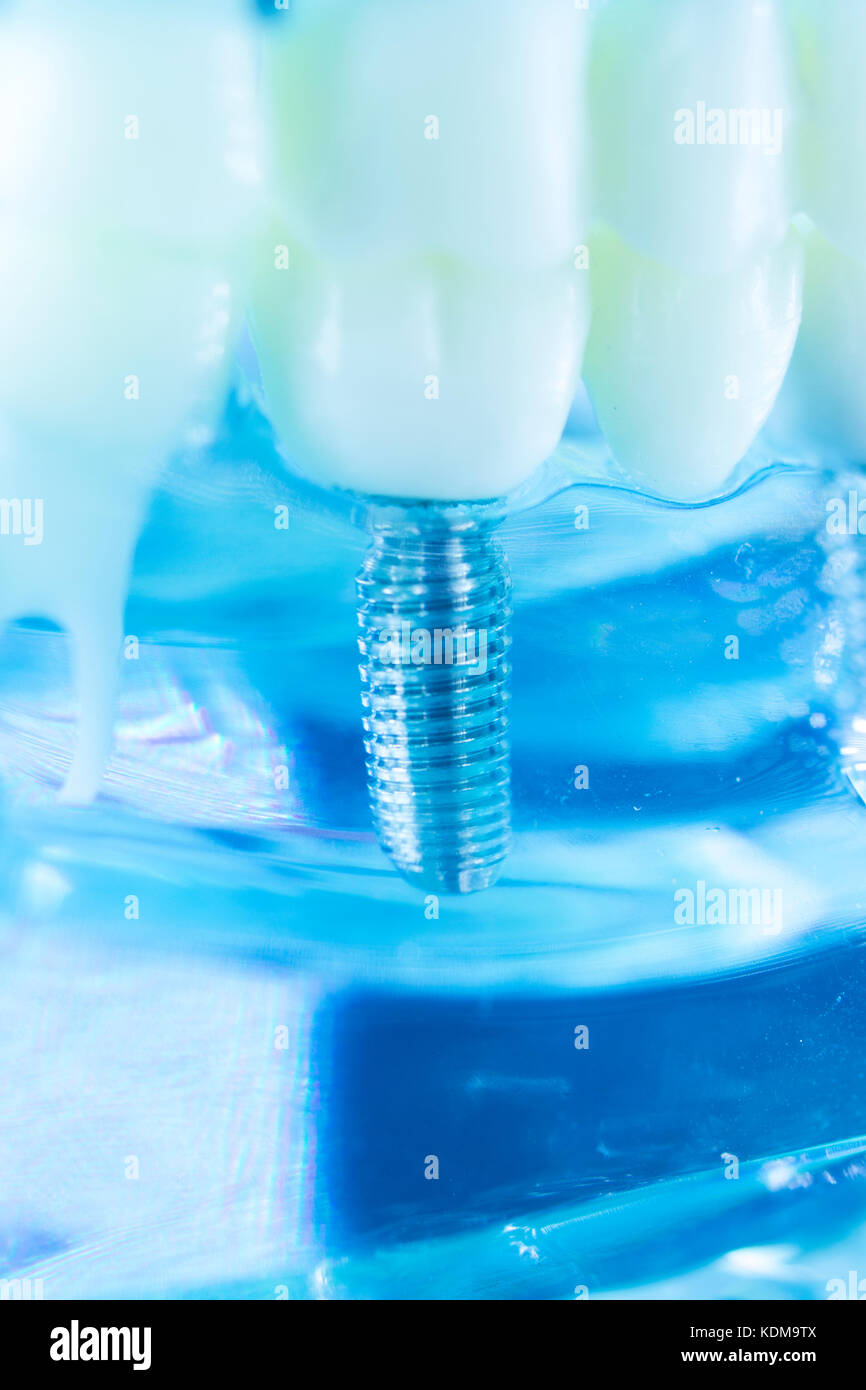 Dental titanium aesthetic orthodontic tooth implant in dentists mouth ...