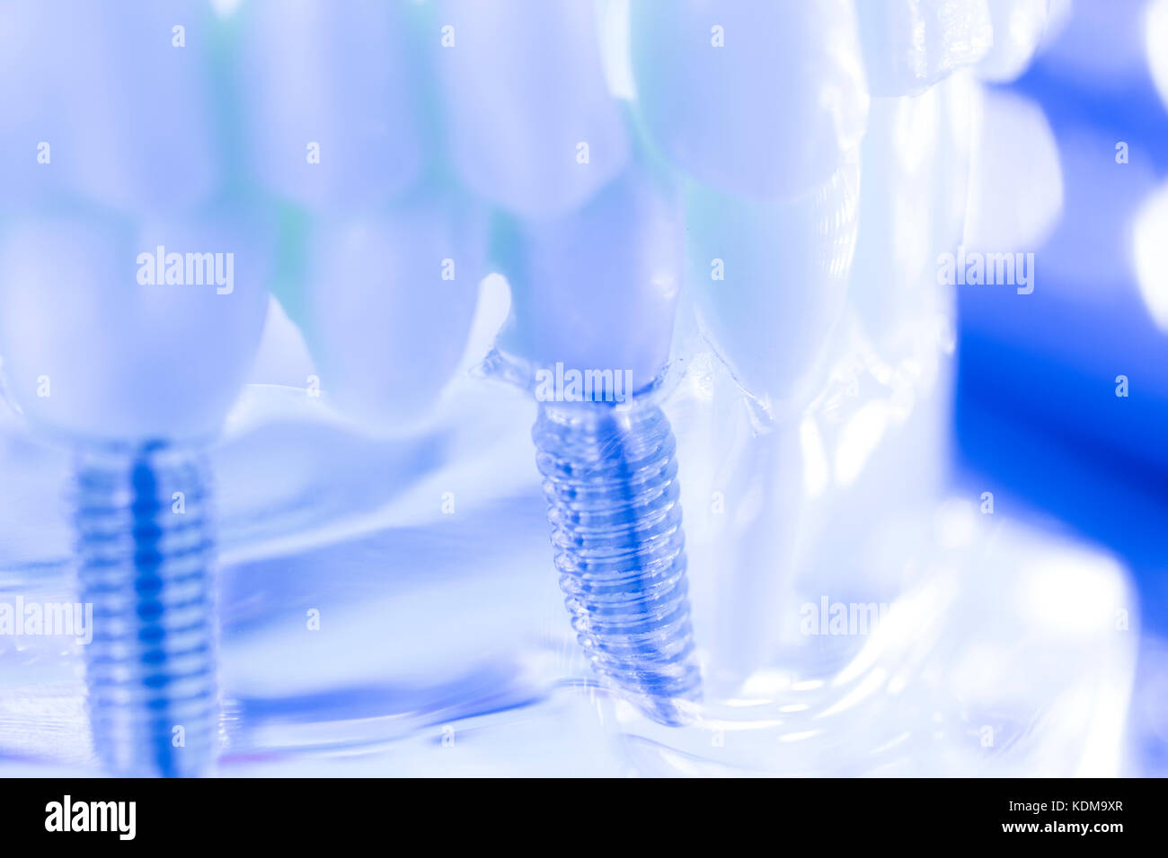 Dental titanium aesthetic orthodontic tooth implant in dentists mouth ...