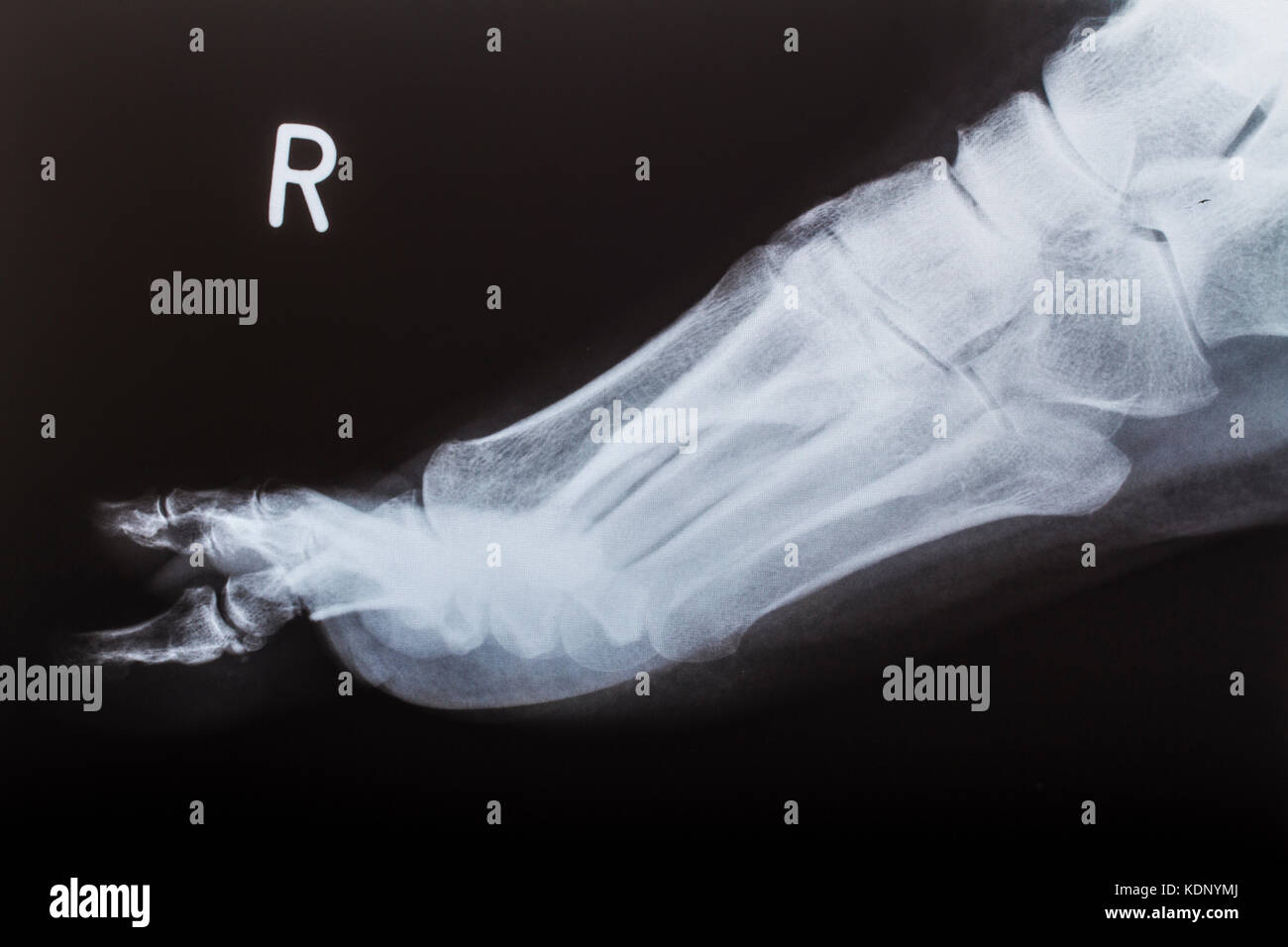X-ray image of human foot on black background Stock Photo - Alamy