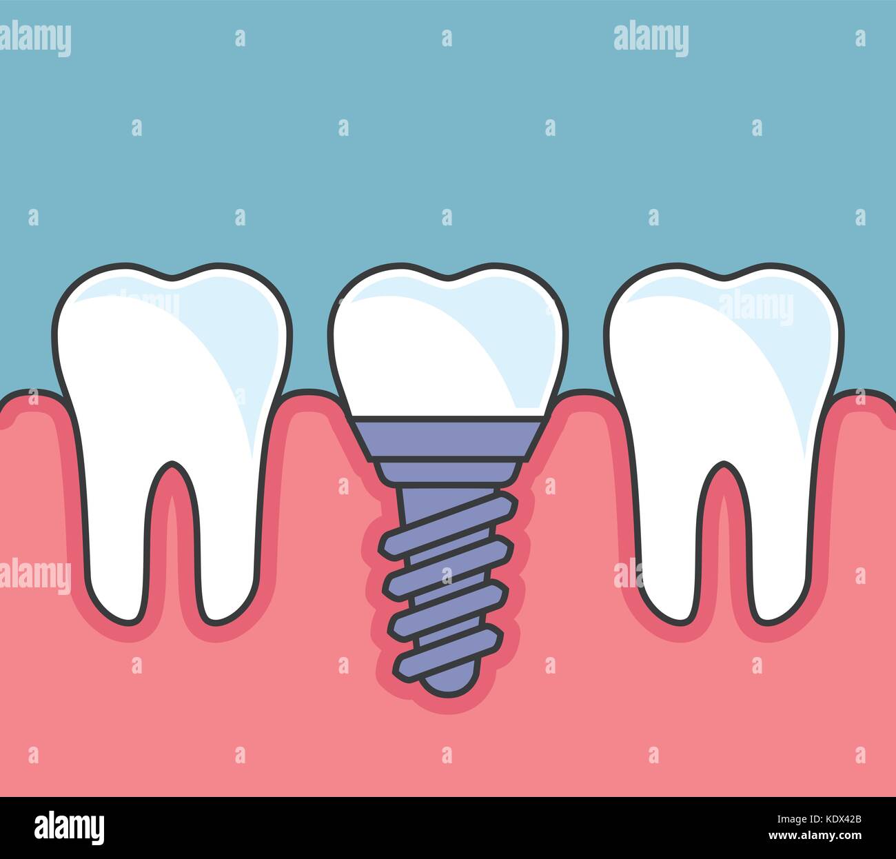 Row of teeth with dental implant - dental prosthetics Stock Vector ...