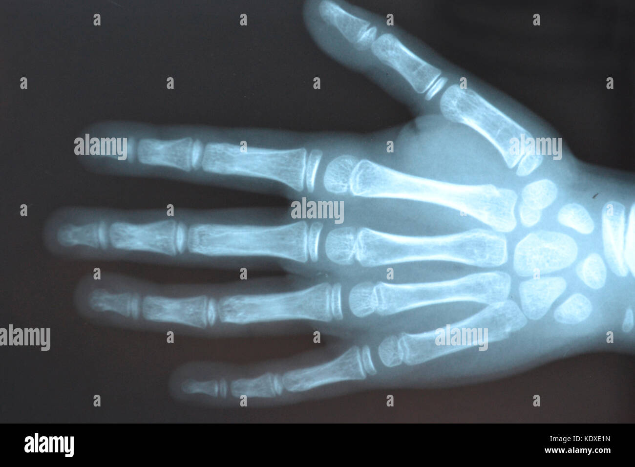 Hand bones on black surface radiography image Stock Photo - Alamy