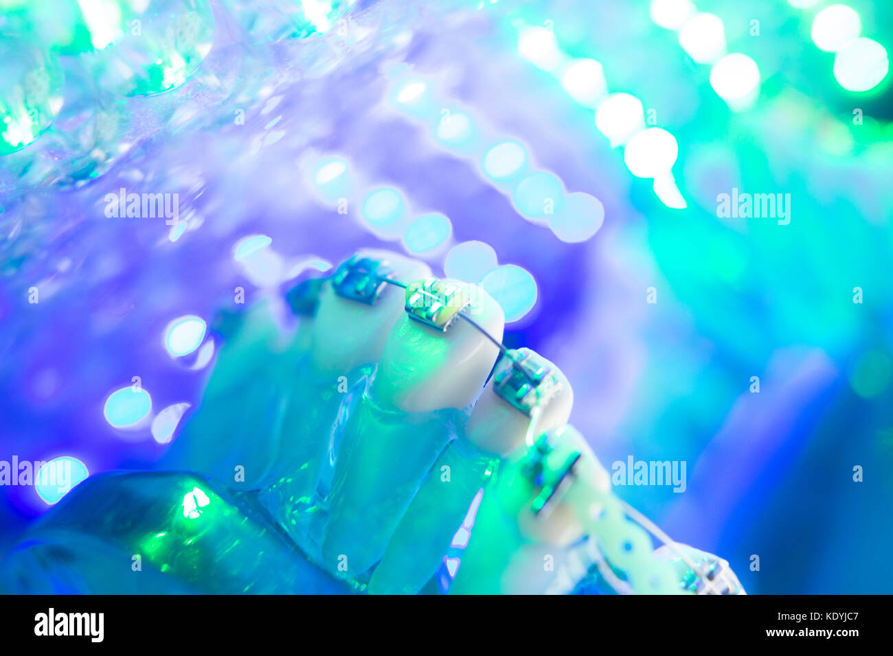 Dental teeth retainers metal aligners brackets to straighten teeth in ...