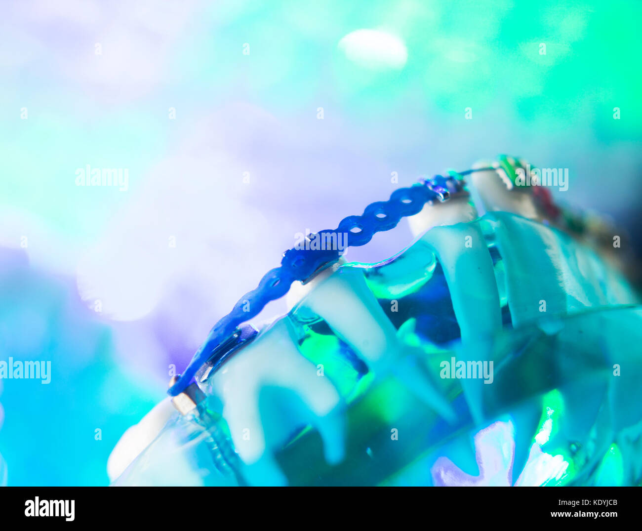 Dental teeth retainers metal aligners brackets to straighten teeth in ...