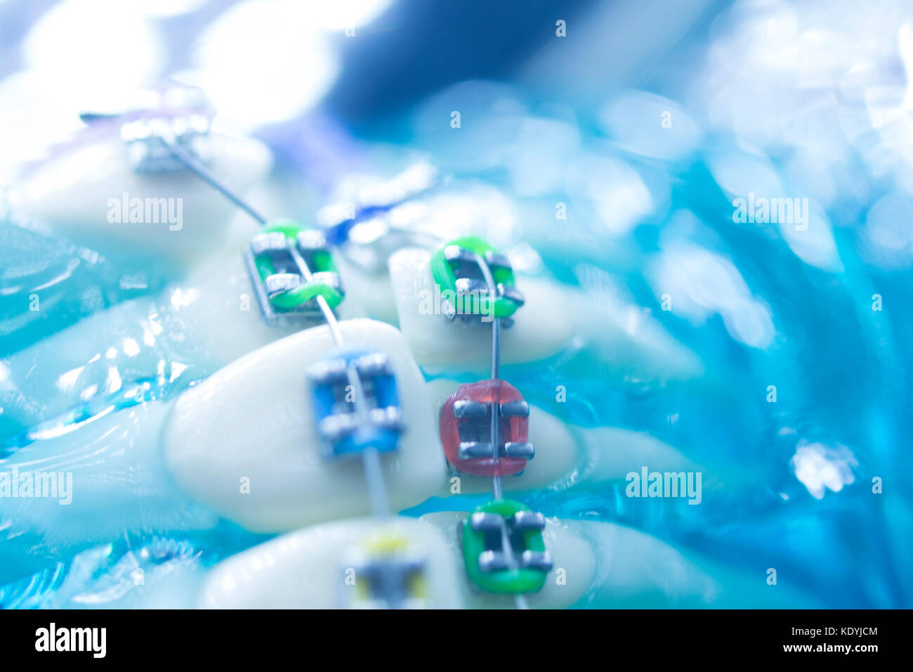 Dental teeth retainers metal aligners brackets to straighten teeth in ...