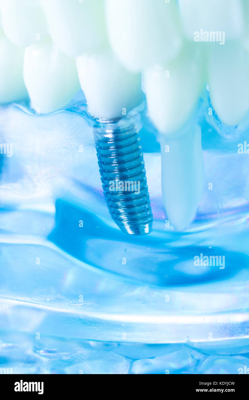 Dental titanium aesthetic orthodontic tooth implant in dentists mouth ...