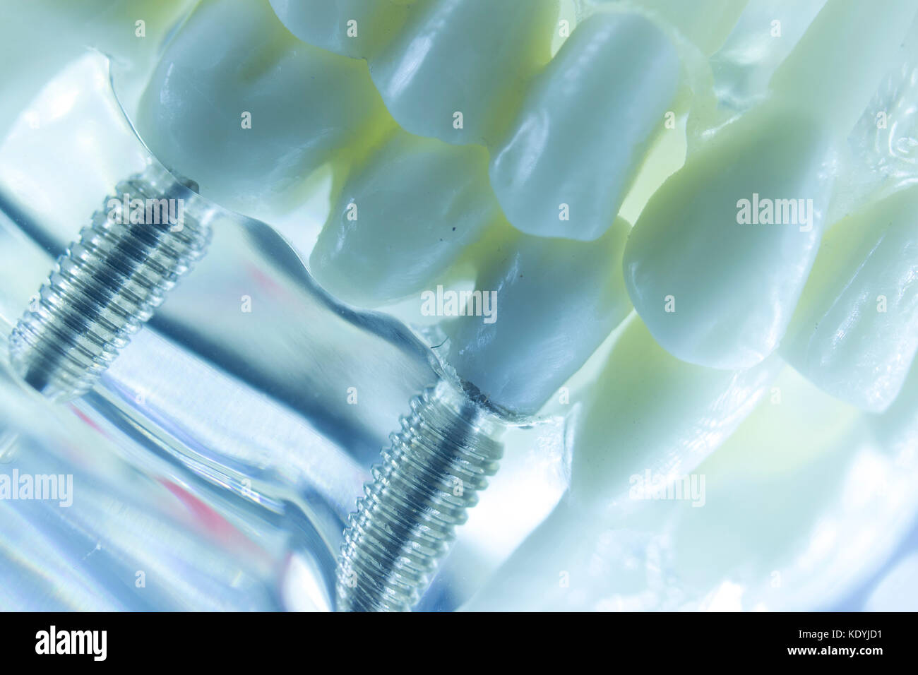 Dental titanium aesthetic orthodontic tooth implant in dentists mouth ...