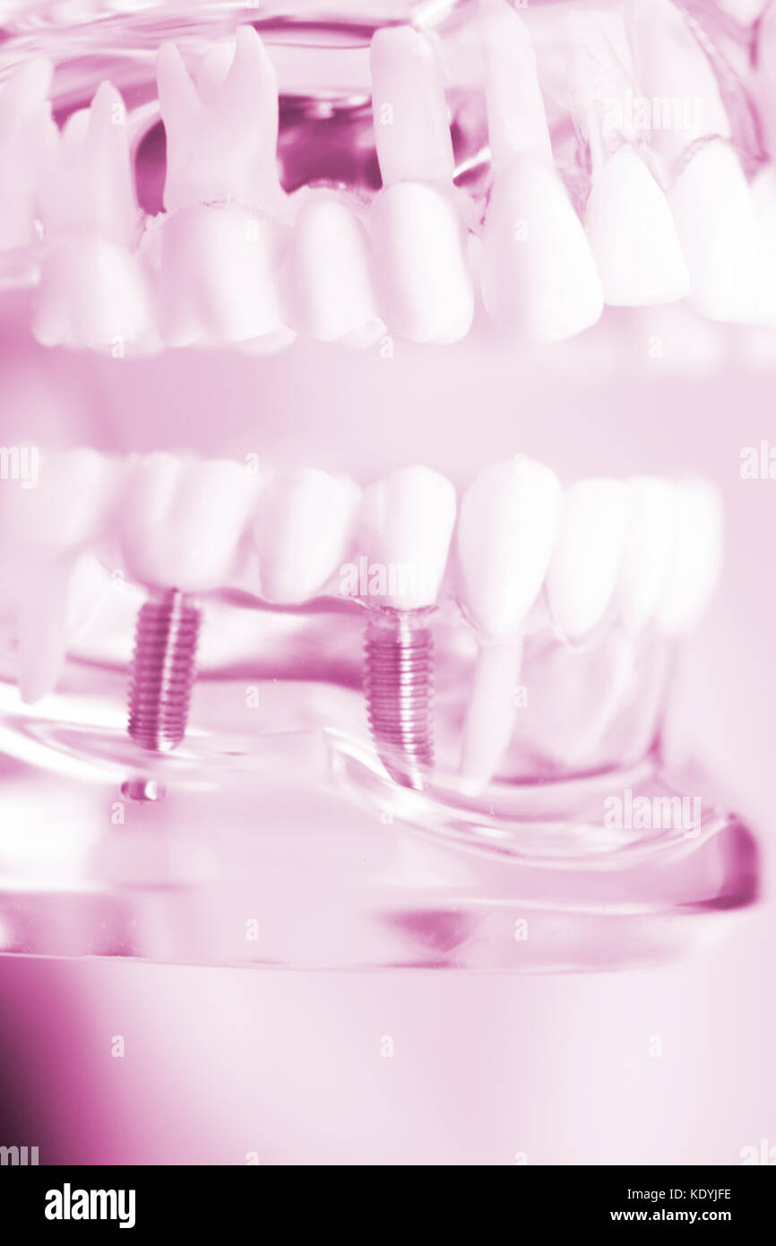 Dental teeth mouth dentists teaching model with teeth, gums, molars and ...