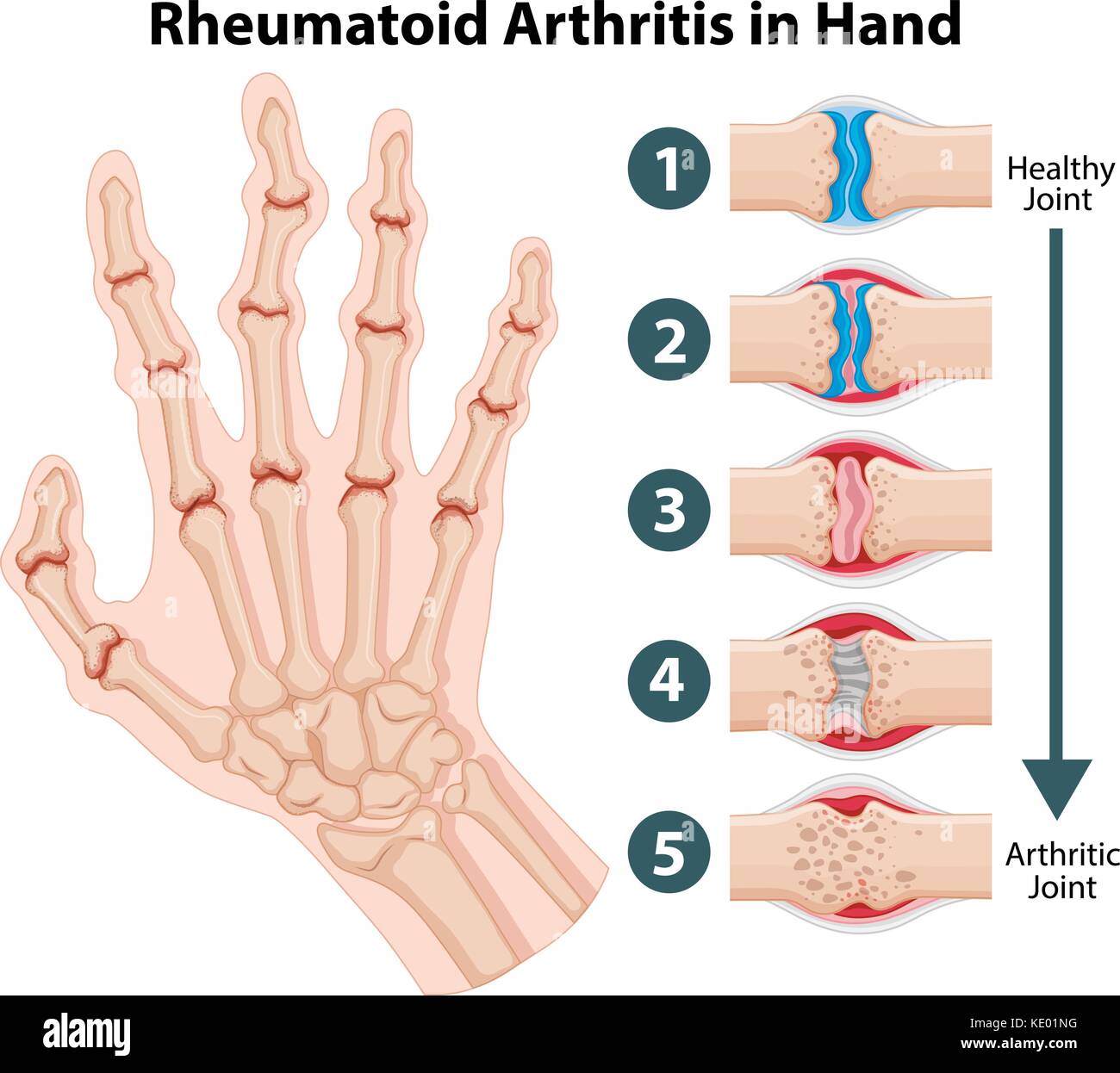 Rheumatoid arthritis drawing Stock Vector Images - Alamy