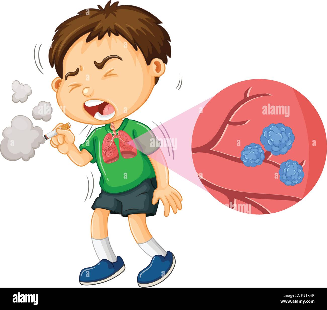 Lung Cancer Drawing Stock Photos & Lung Cancer Drawing Stock Images - Alamy