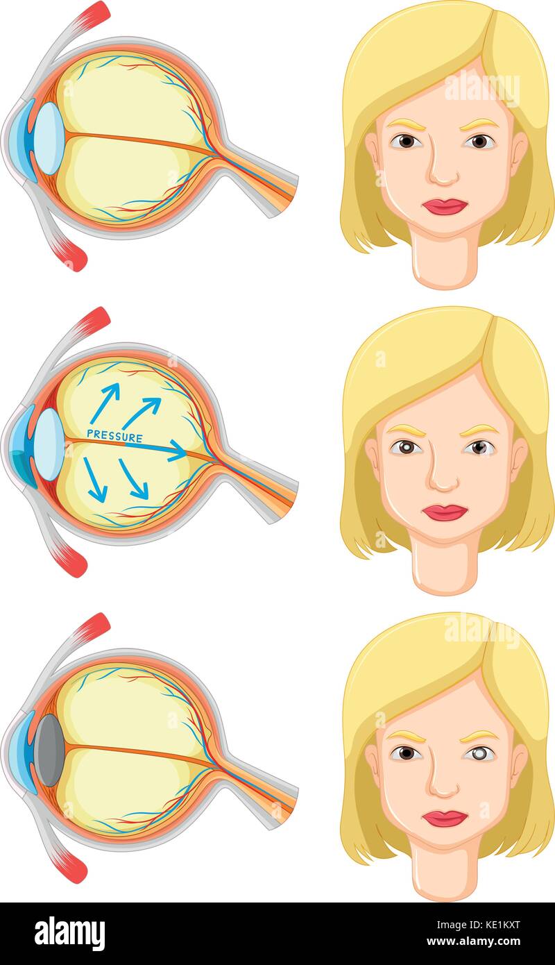 Diagram showing eye problem in human illustration Stock Vector Image ...