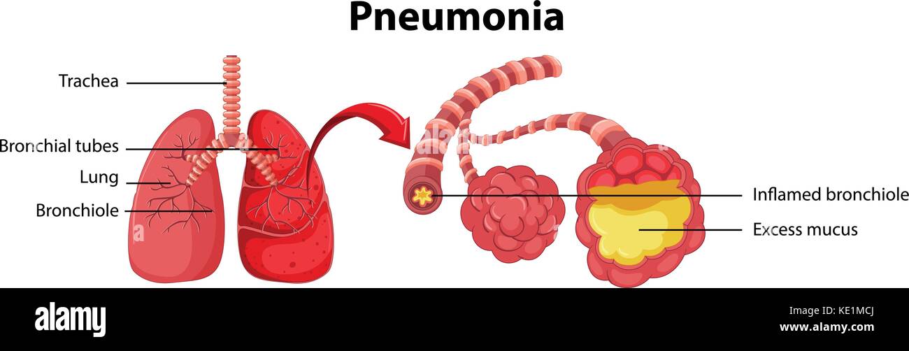 Pneumonia Vector Vectors Stock Photos & Pneumonia Vector Vectors Stock ...