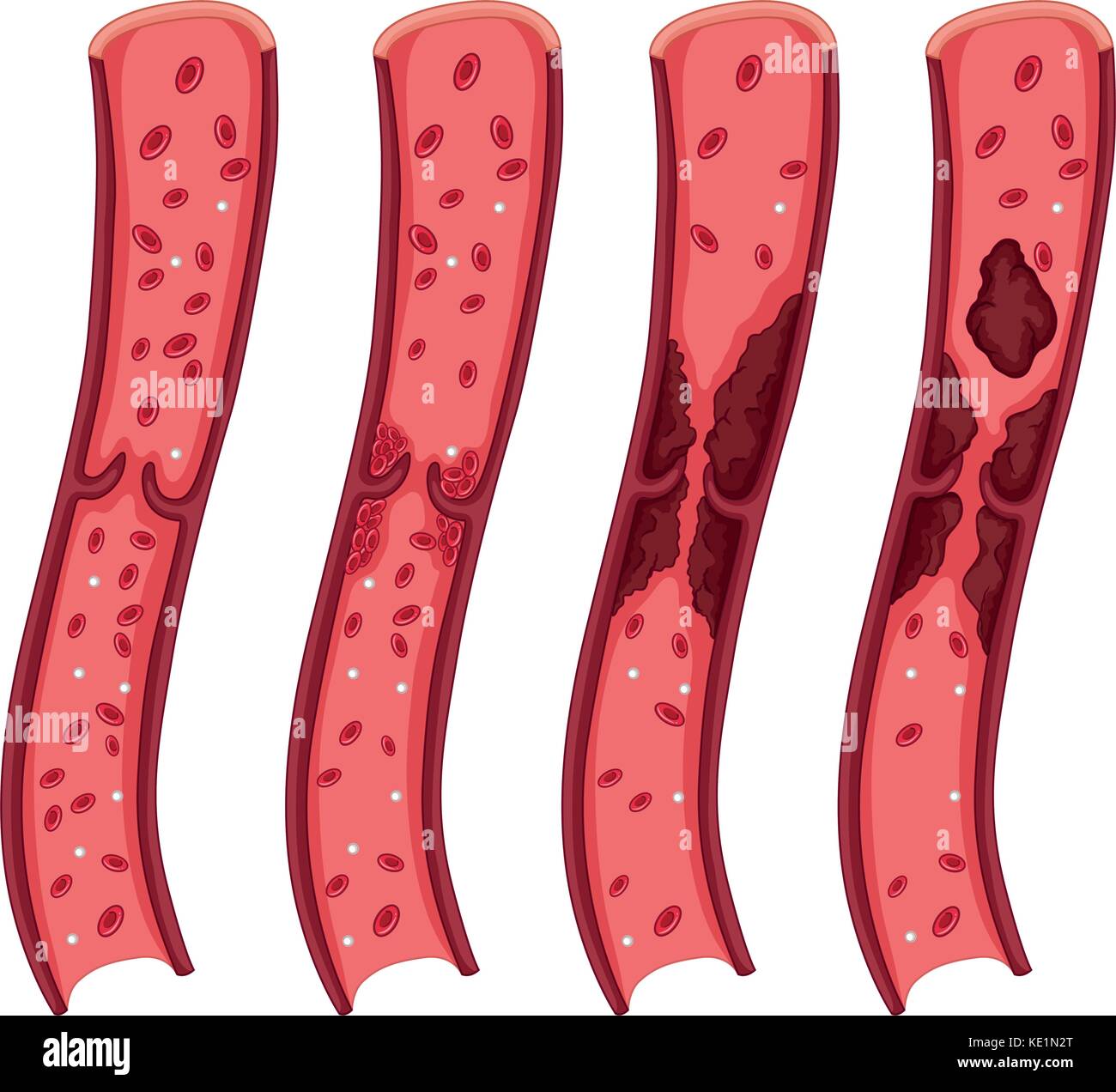 Blood clot diagram on white illustration Stock Vector Image & Art - Alamy