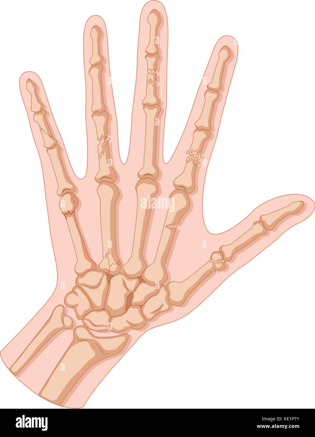 Inside of hand fracture illustration Stock Vector Image & Art - Alamy