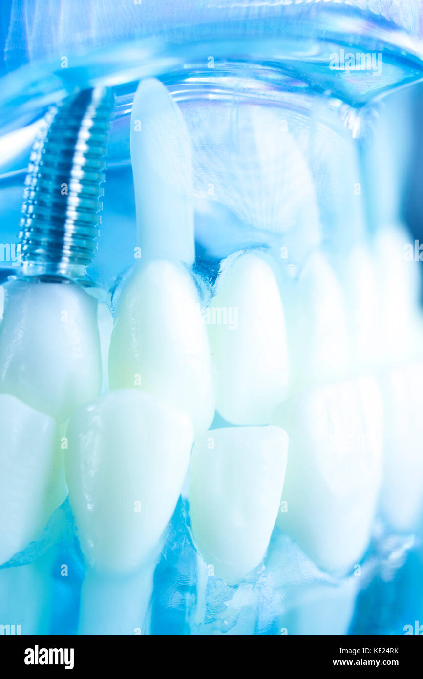 Dental titanium aesthetic orthodontic tooth implant in dentists mouth ...