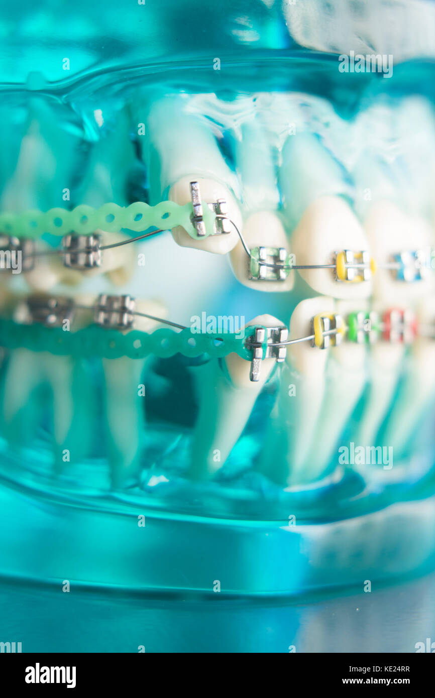 Dental teeth retainers metal aligners brackets to straighten teeth in ...