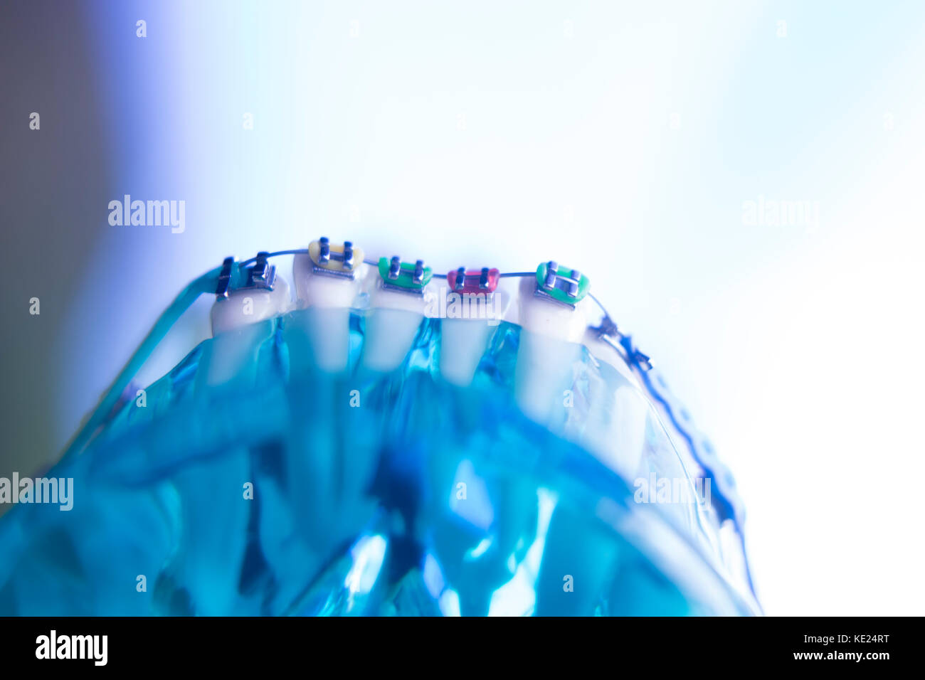 Dental teeth retainers metal aligners brackets to straighten teeth in ...