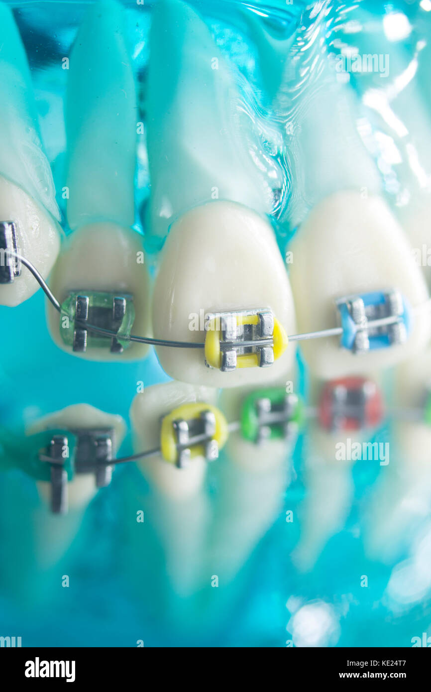 Dental teeth retainers metal aligners brackets to straighten teeth in ...