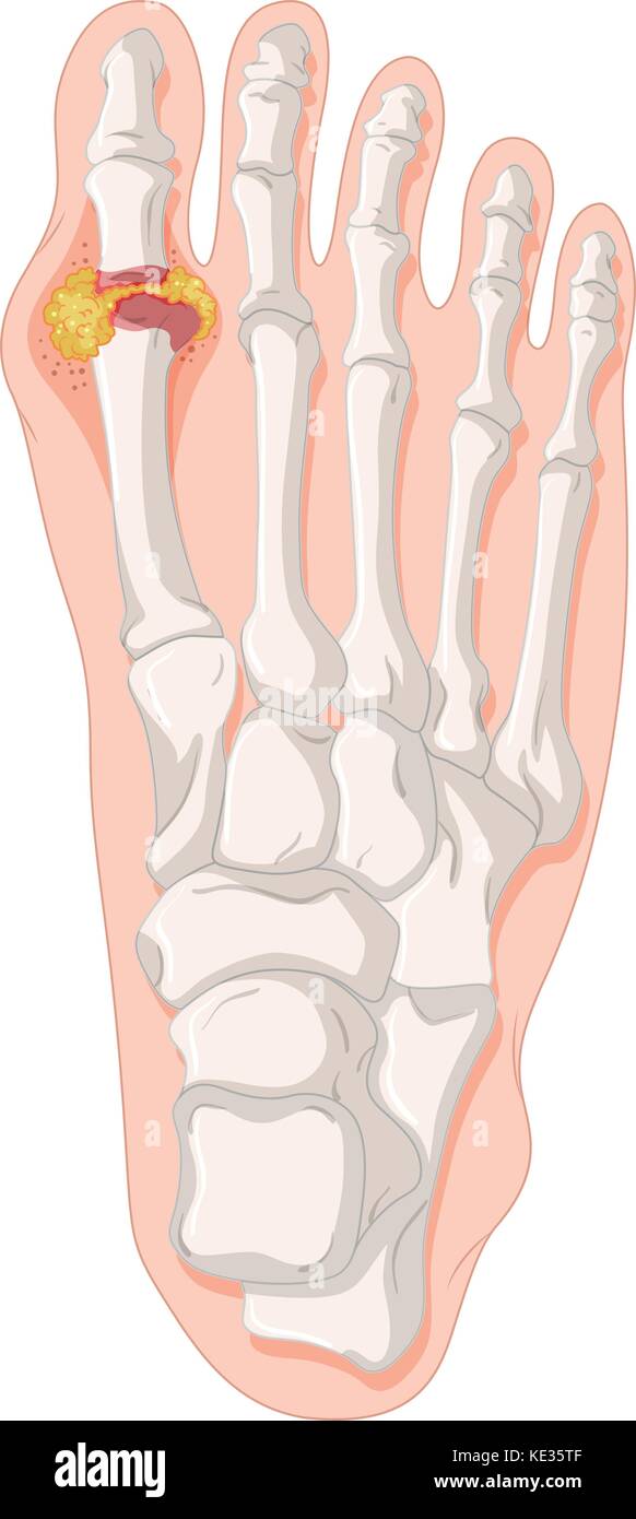 Gout Foot High Resolution Stock Photography and Images - Alamy