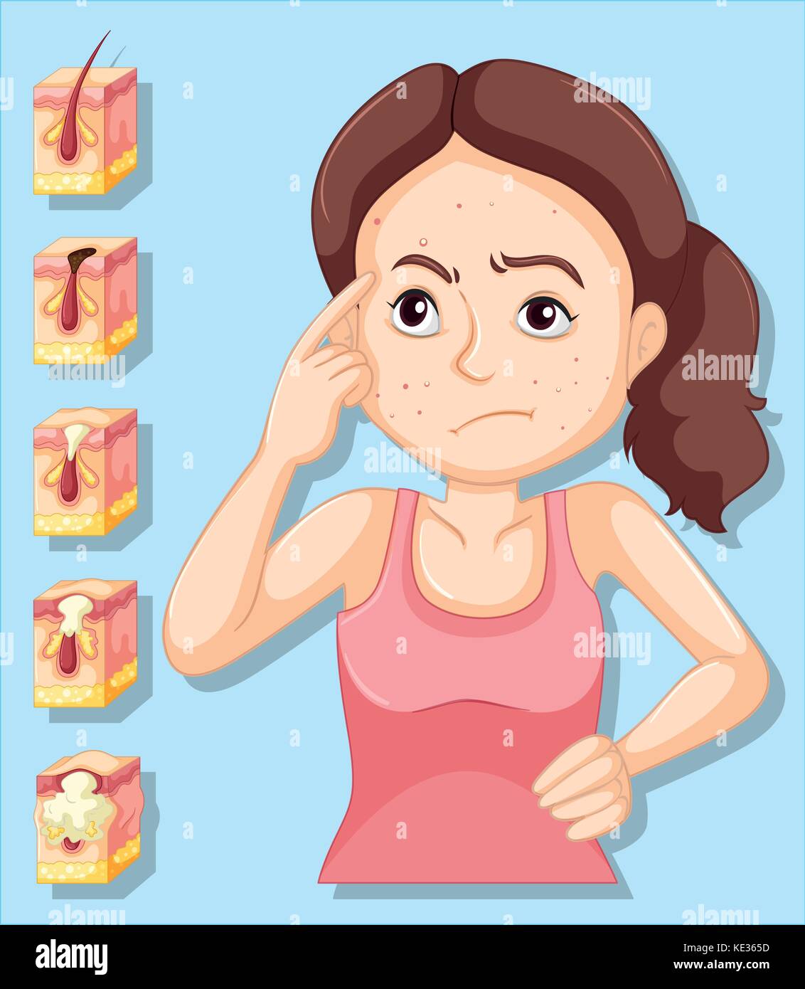 Pimple vector vectors hi-res stock photography and images - Alamy