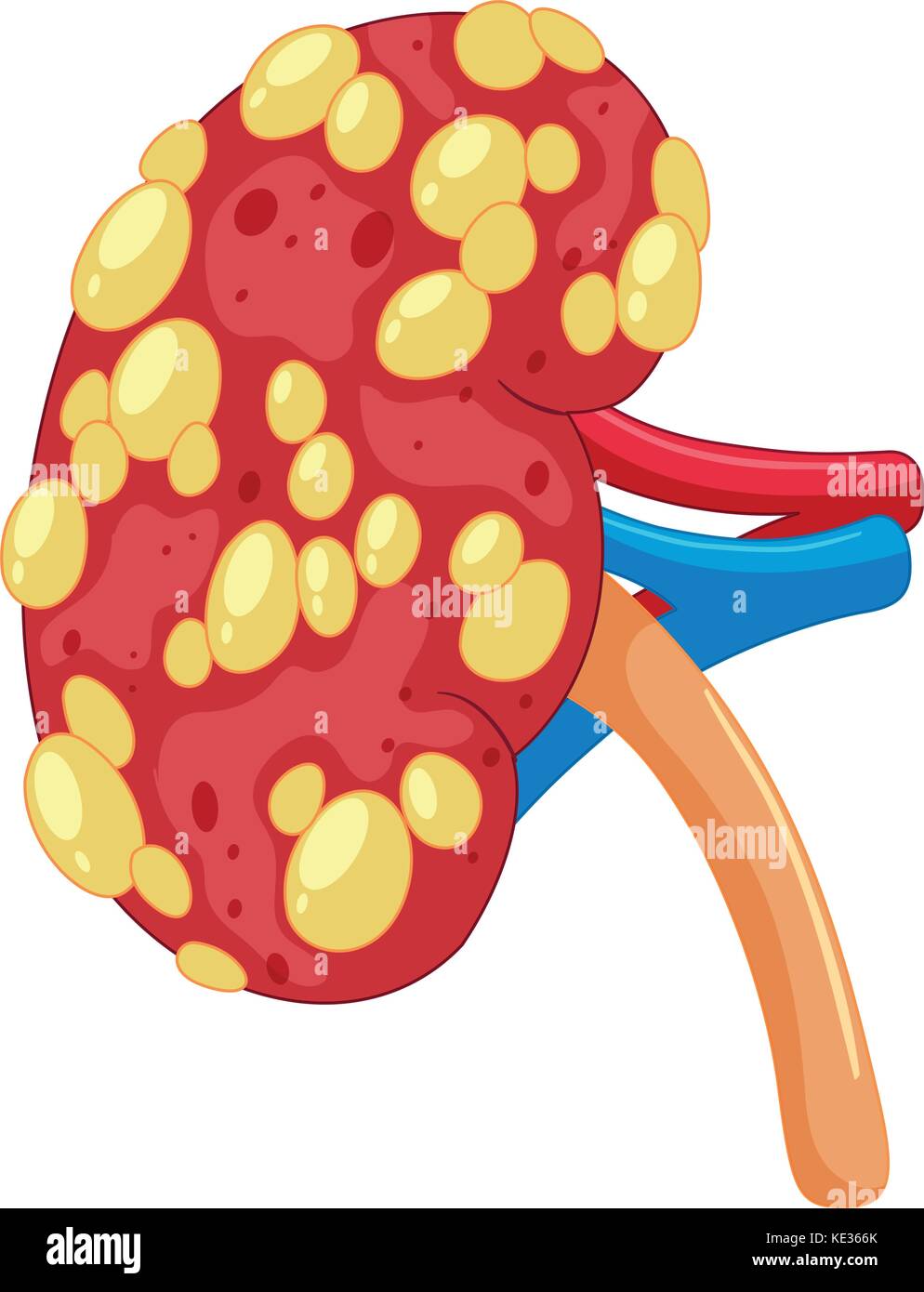 Close up kidney with disease illustration Stock Vector Image & Art - Alamy