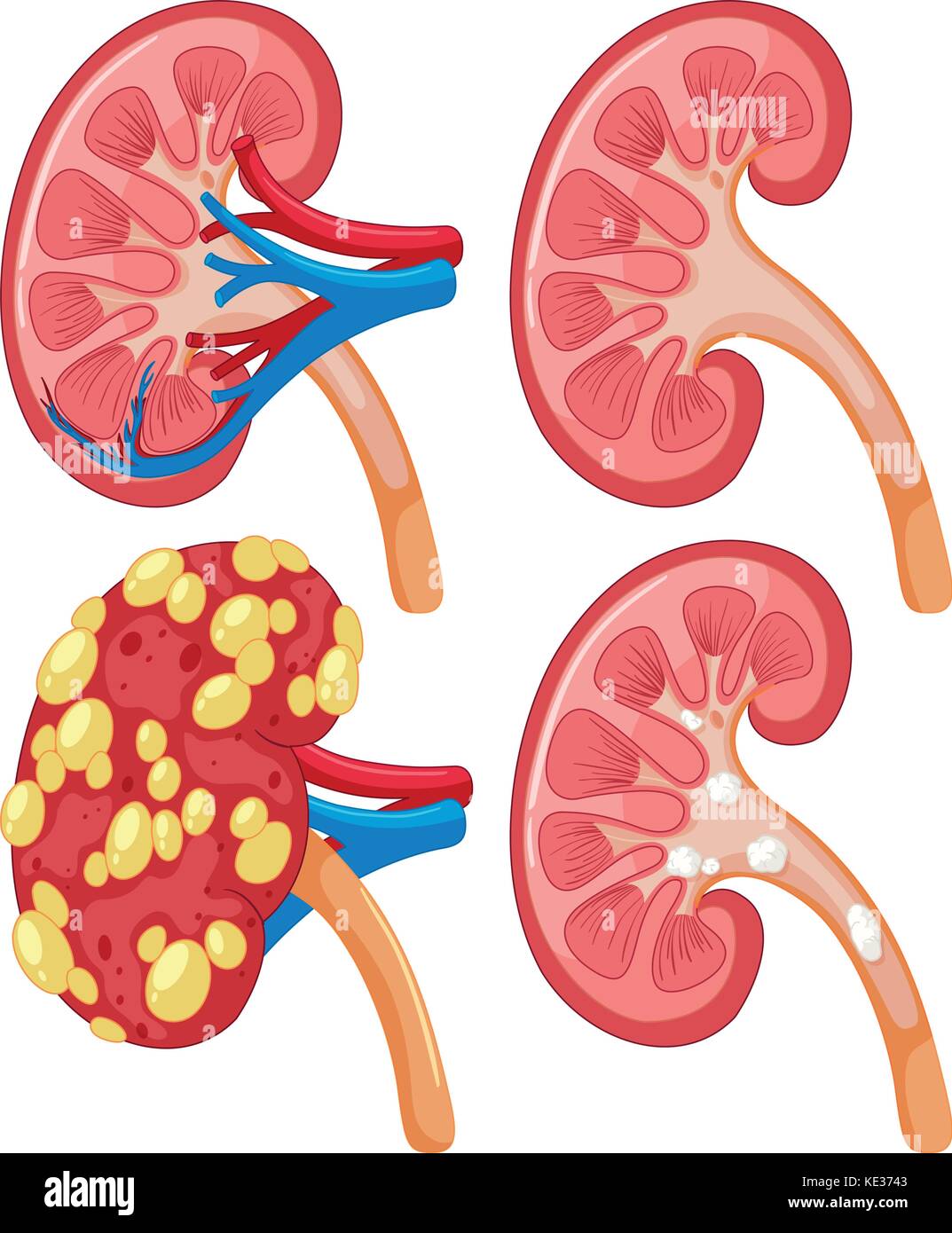 Diagram of kidney with disease illustration Stock Vector Image & Art ...