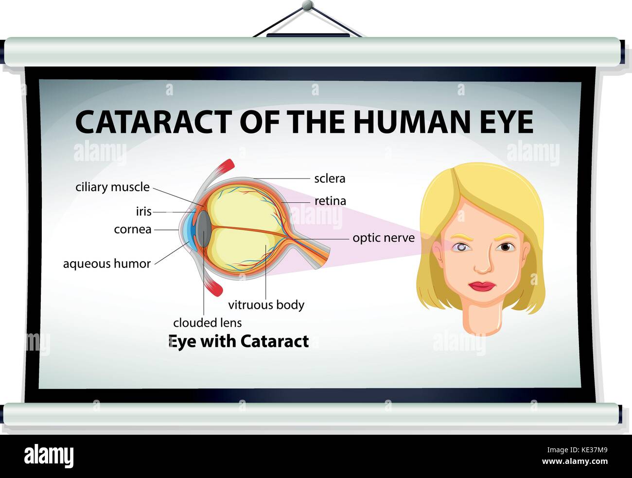 Chart showing cataract of human eye illustration Stock Vector Image ...