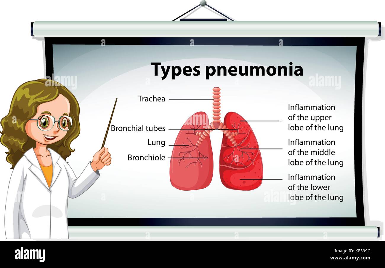 Doctor explaining types of pneumonia illustration Stock Vector Image ...