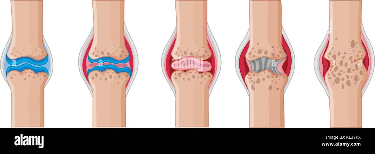 Rheumatoid arthritis drawing hi-res stock photography and images - Alamy