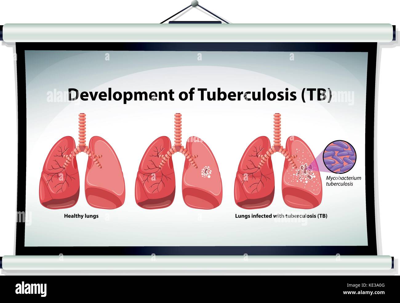 Chart showing development of Tuberculosis illustration Stock Vector ...