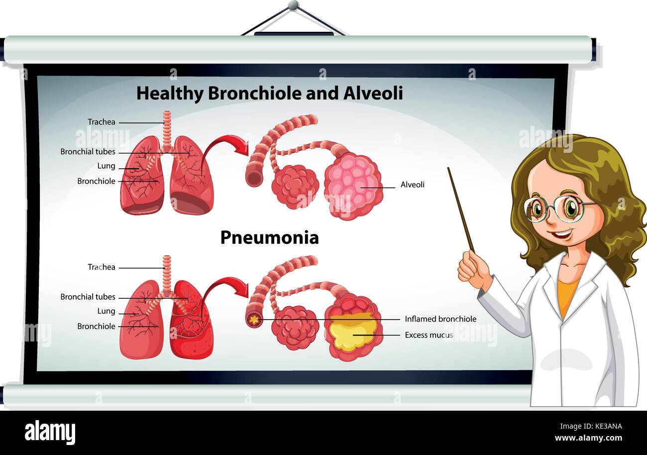 Doctor explaining healthy bronchiole and alveoli illustration Stock ...