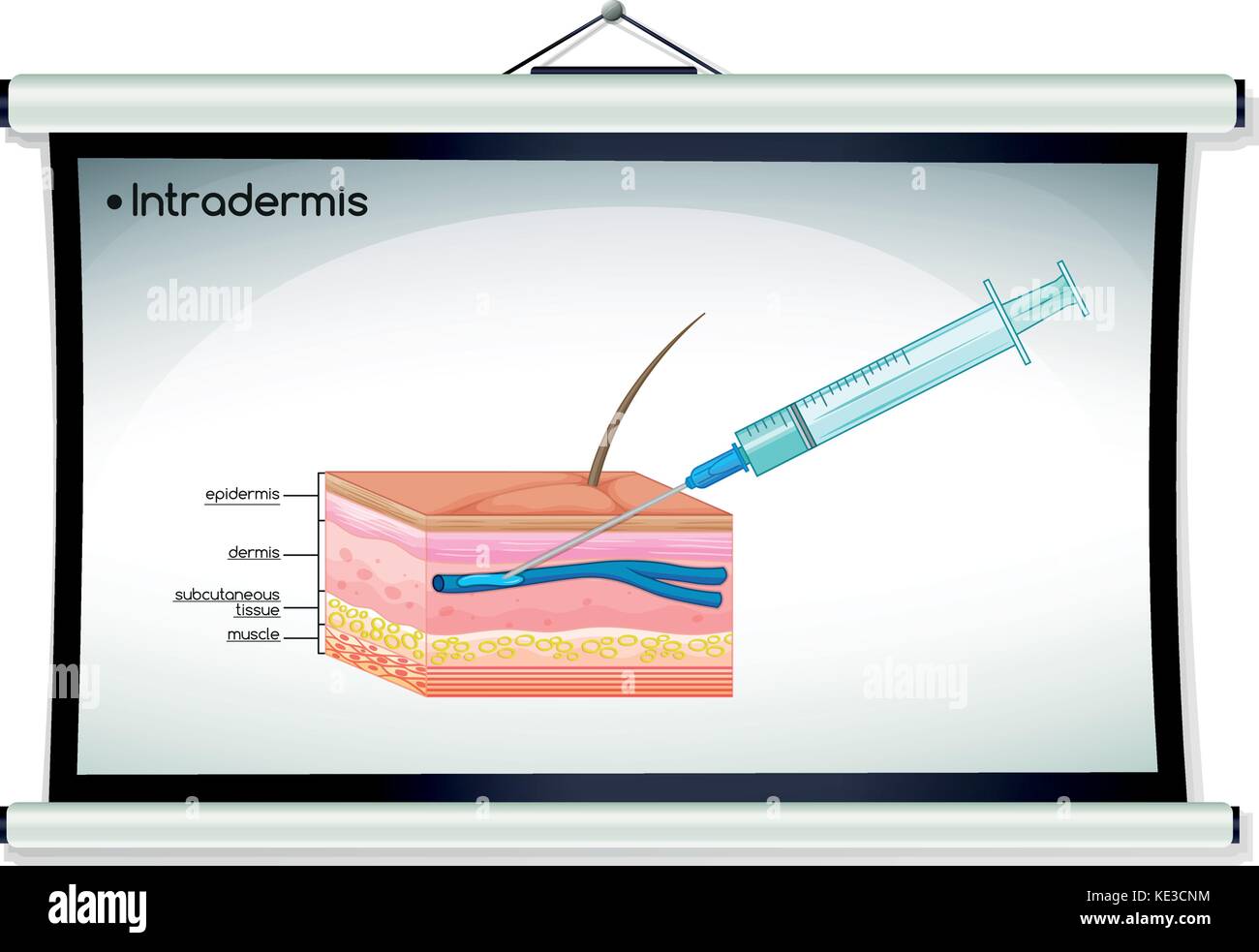 Diagram showing intradermis injection illustration Stock Vector Image ...