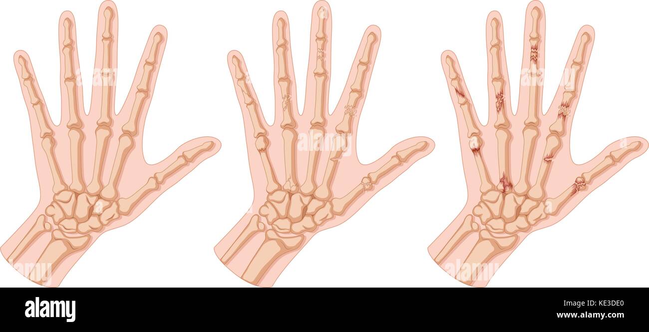Human hands with bone fracture illustration Stock Vector Image & Art ...