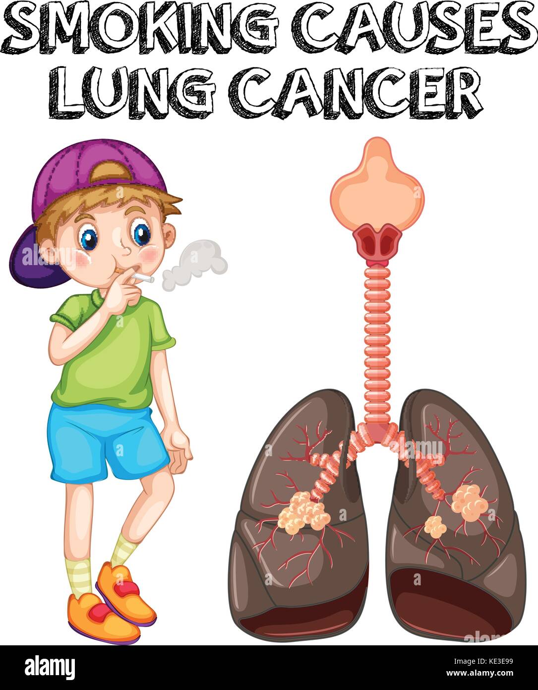 Lung Cancer Drawing Stock Photos & Lung Cancer Drawing Stock Images - Alamy