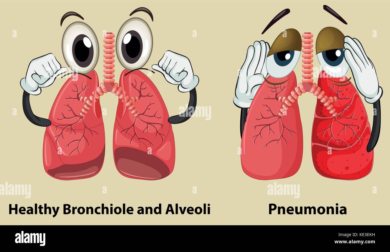 Pneumonia Lungs Diagram