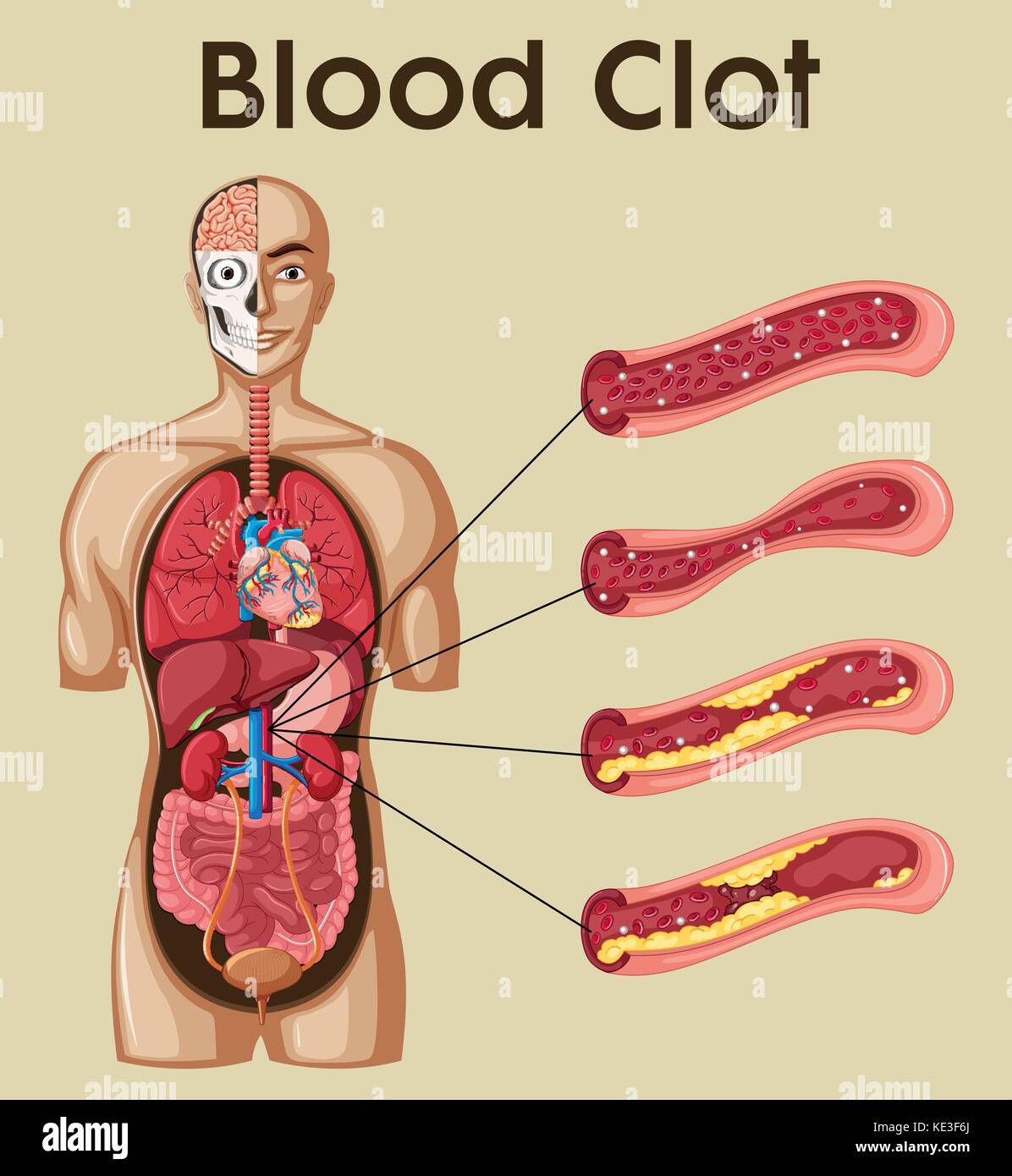 Diagram showing blood clot in human illustration Stock Vector Image ...