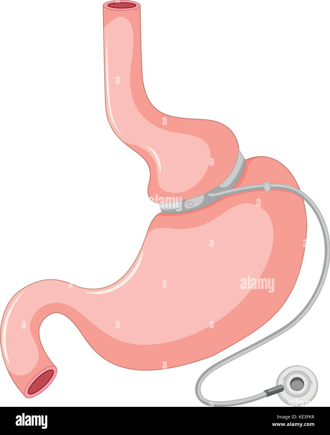 Close up picuture of lap band on stomach illustration Stock Vector ...