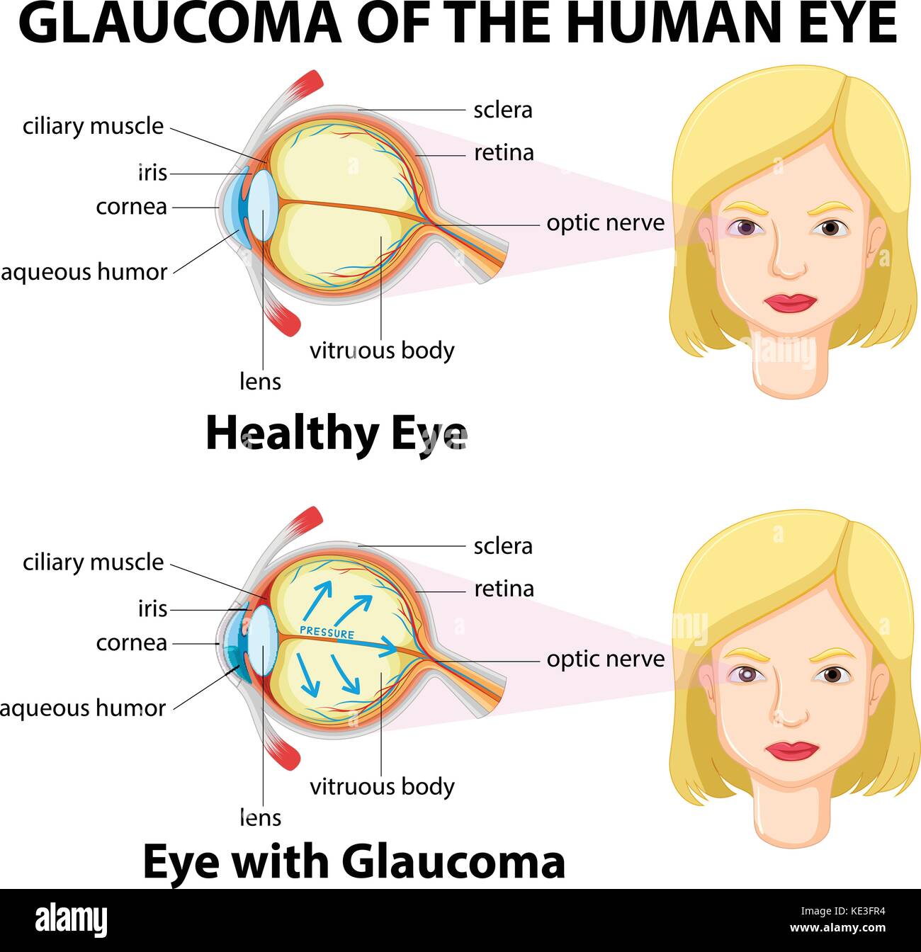 Glaucoma diagram hi-res stock photography and images - Alamy