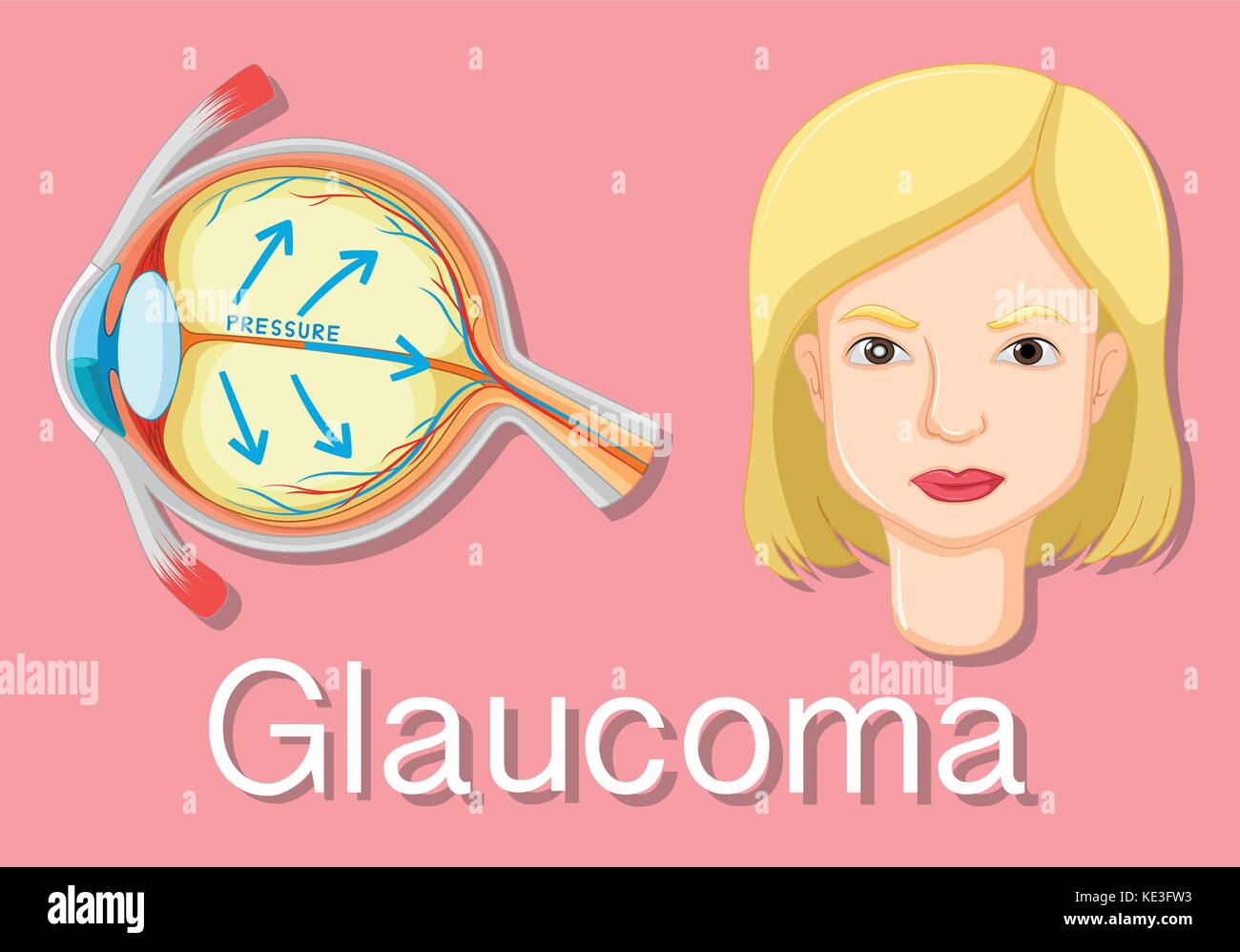 Diagram showing eyes with glaucoma illustration Stock Vector Image ...