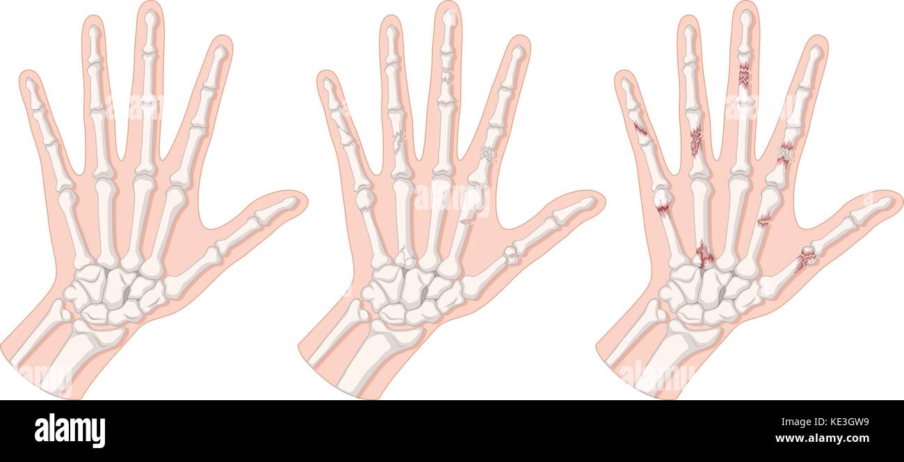 Diagram showing hand fracture illustration Stock Vector Image & Art - Alamy