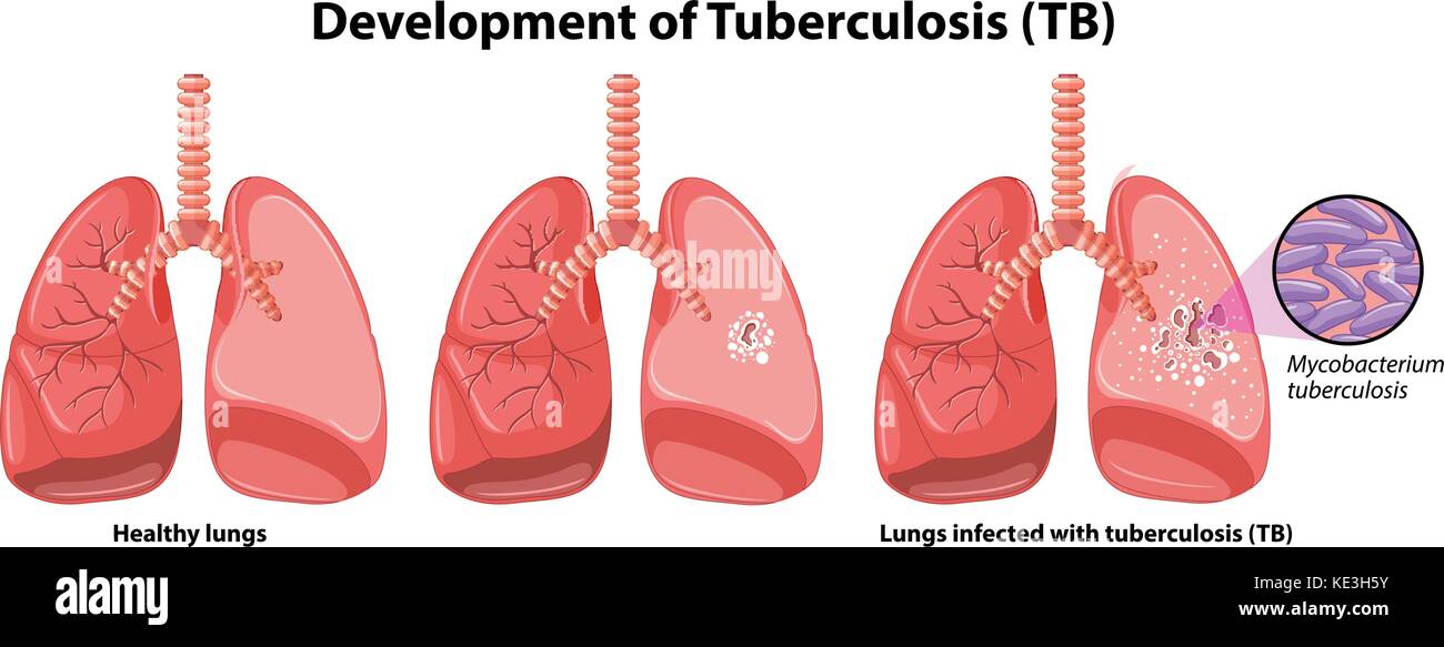Chart showing development of tuberculosis illustration Stock Vector ...
